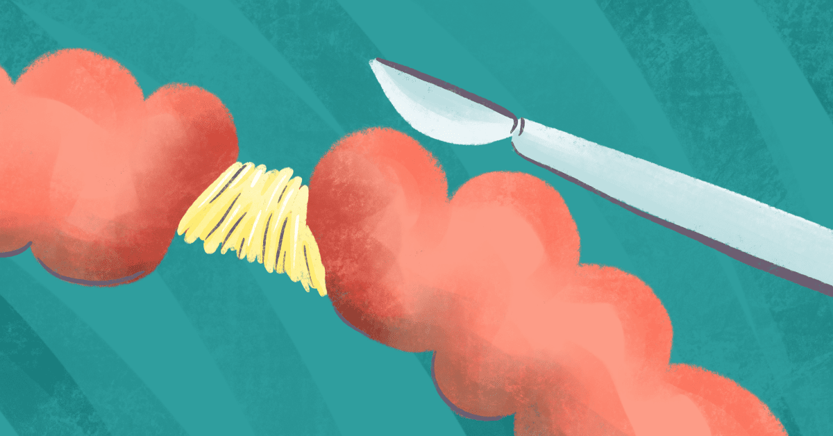 Strictureplasty for Crohn's Disease | InflammatoryBowelDisease.net