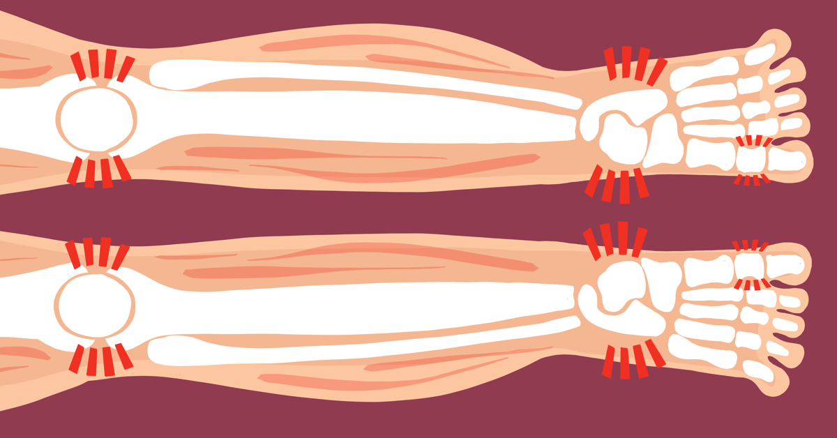 Crohn's Joint Pain and Arthritis